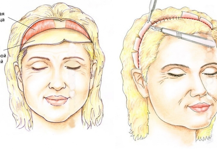 Fronto-temporal lifting is an effective way to lift the forehead and ...