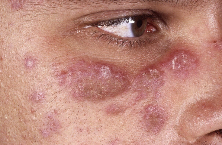 The main clinical forms and manifestations of skin tuberculosis - Estet ...