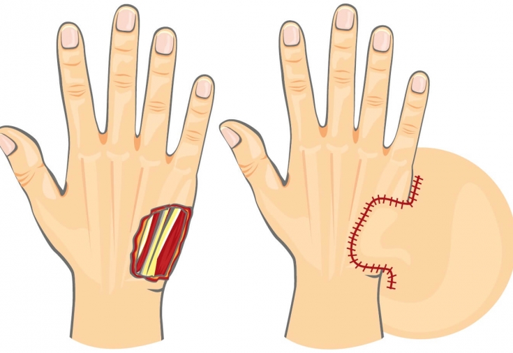 Surgical treatment of burns: graft harvesting - Estet-Portal