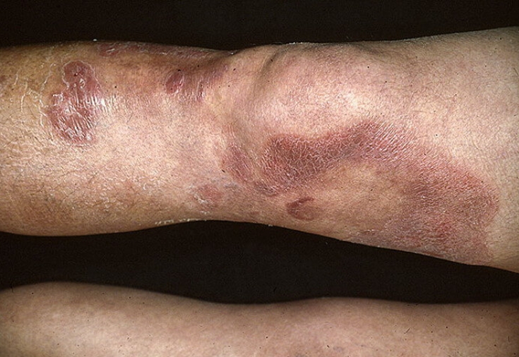 Clinical case of complex diagnosis of skin T-cell lymphoma. Part 1 ...
