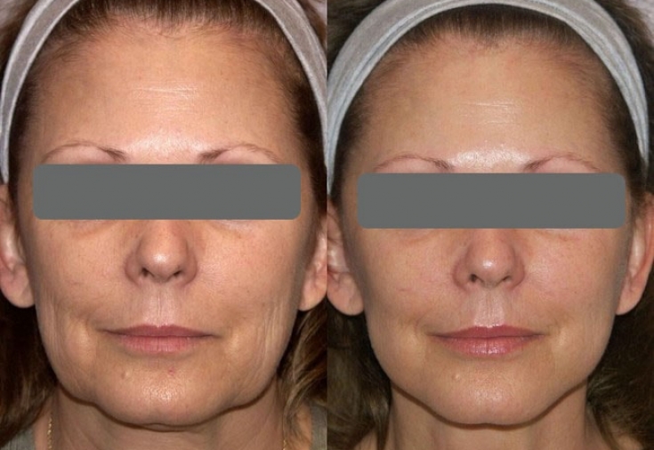 Ease and effectiveness of threadlifting with V-line threads - Estet-Portal