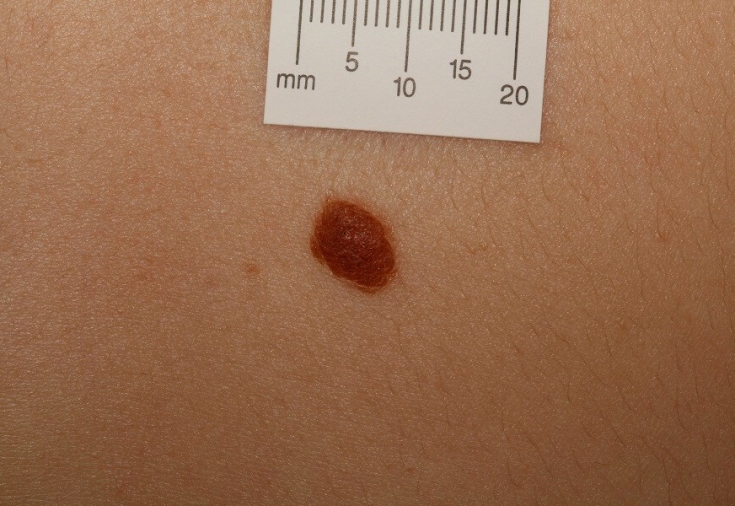 The main types of nevi: diagnosis and treatment - Estet-Portal