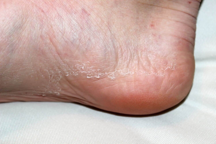 Ways of infection, causes, symptoms and diagnosis of dermatophytosis ...