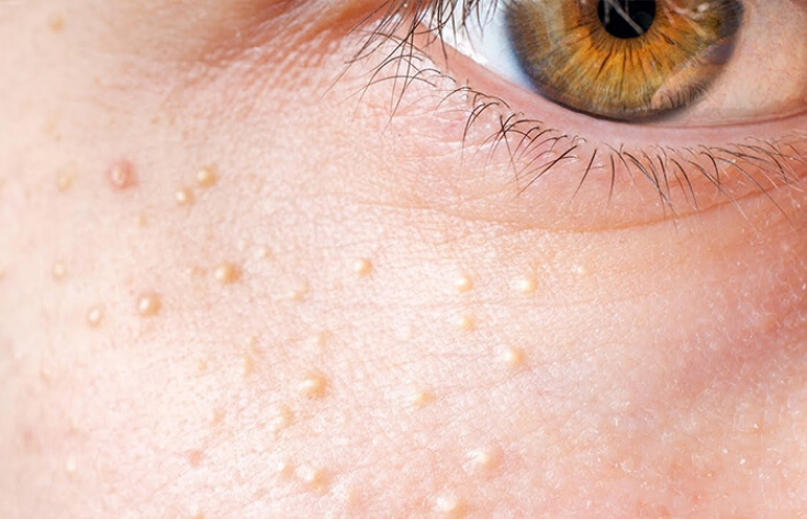 Colloidal milium: causes and methods of treatment of the disease ...