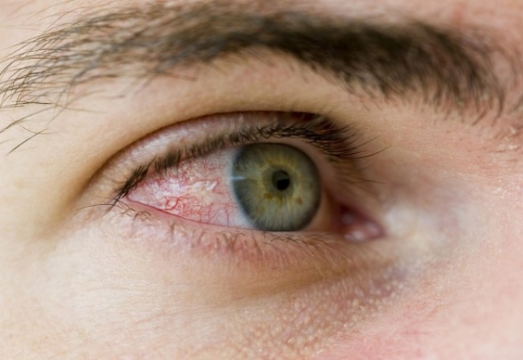 Demodex eye or eyelash mite: treatment methods - Estet-Portal