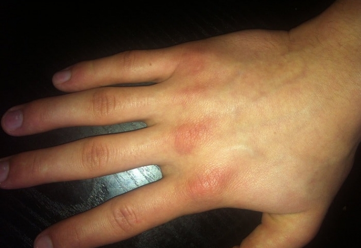 Sharpe's syndrome: why the disease affects mainly women - Estet-Portal