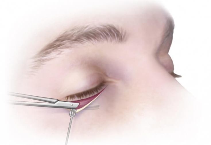 Transconjunctival blepharoplasty or eyelid surgery - Estet-Portal