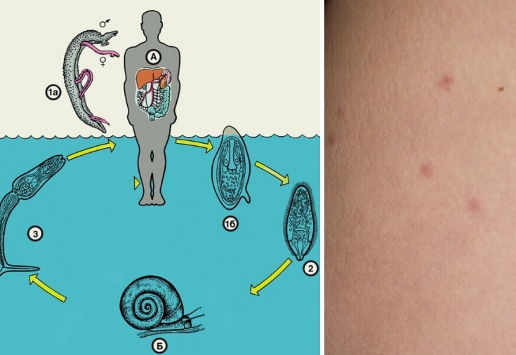 Bather's itch: what aquatic parasites can affect the skin - Estet-Portal